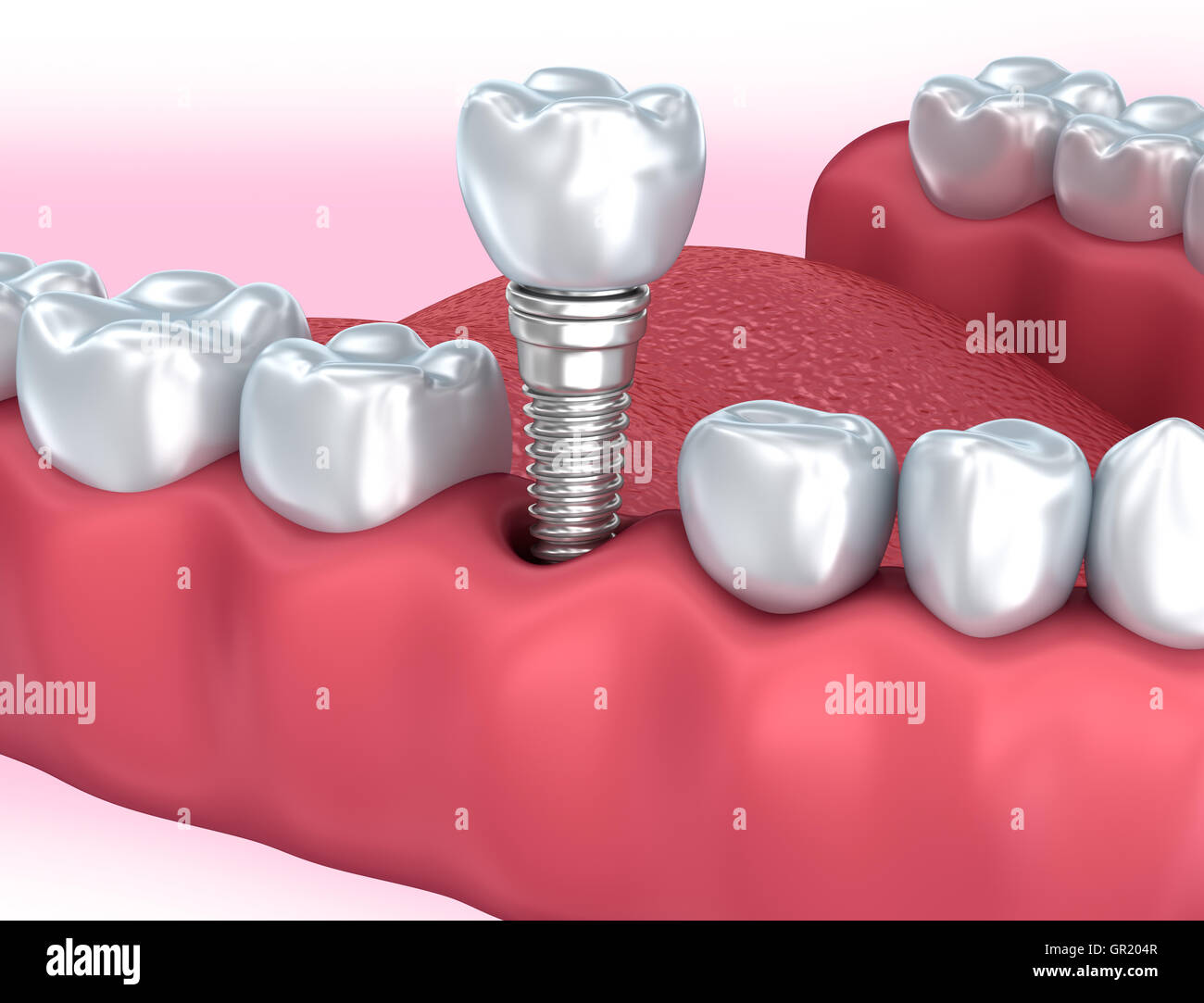 Tooth human implant, Medically accurate 3D illustration Stock Photo - Alamy