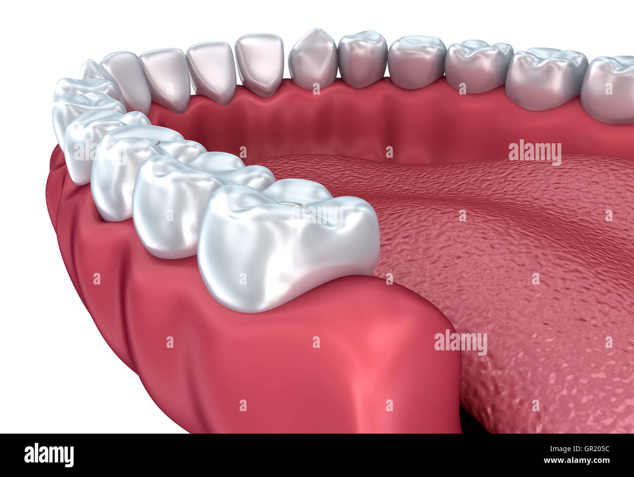 Denture isolated on white . Medically accurate 3D illustration Stock ...