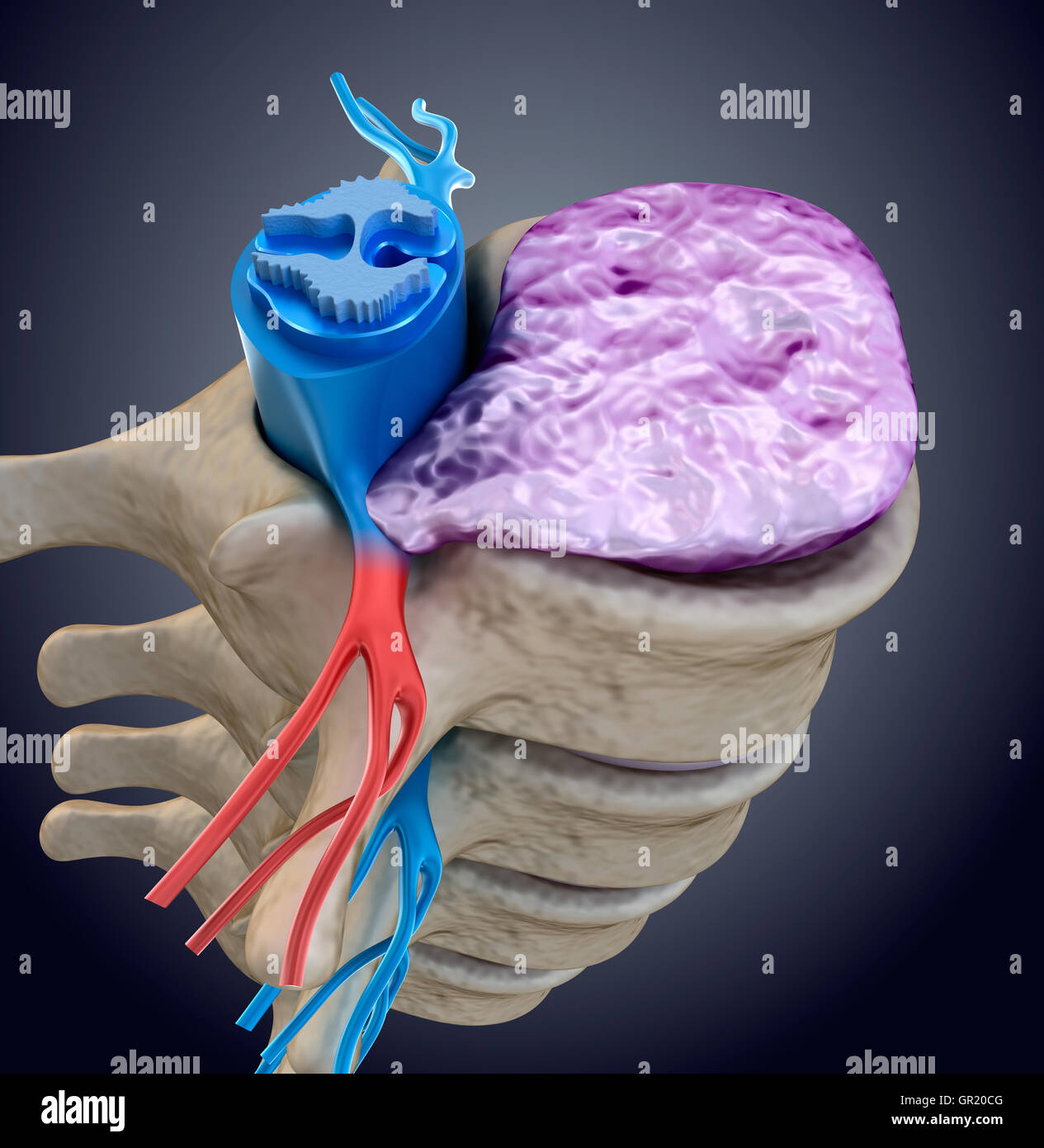 Spinal cord under pressure of bulging disc. Medically accurate 3D ...