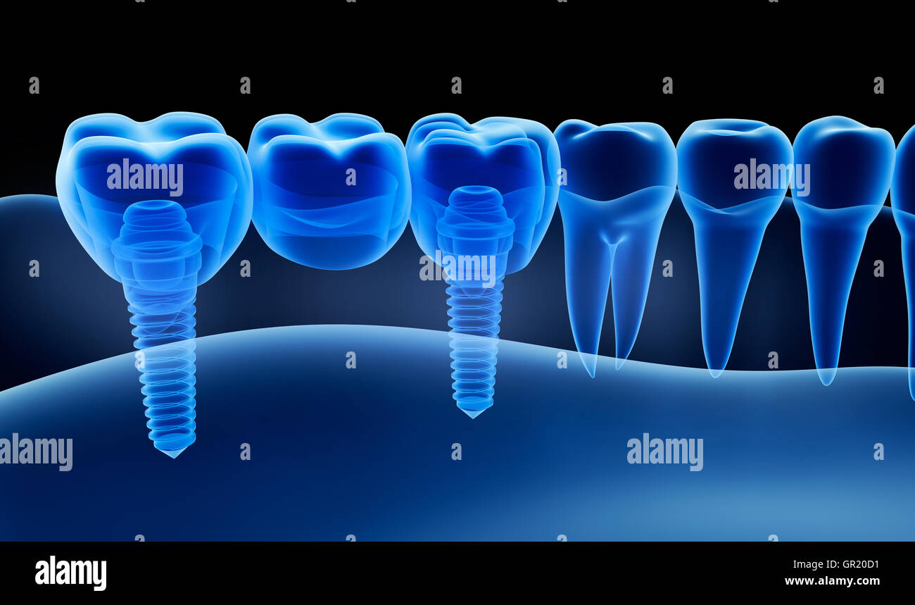 X-ray view of denture with implant. Xray view. Medically accurate 3D ...