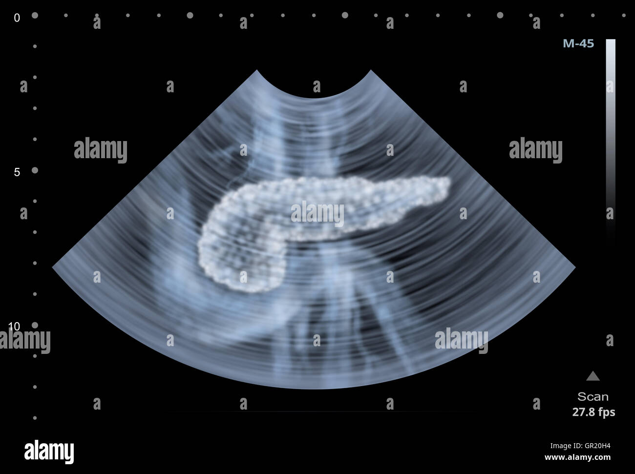 Ultrasound scan of human Pancreas. Illustration Stock Photo - Alamy