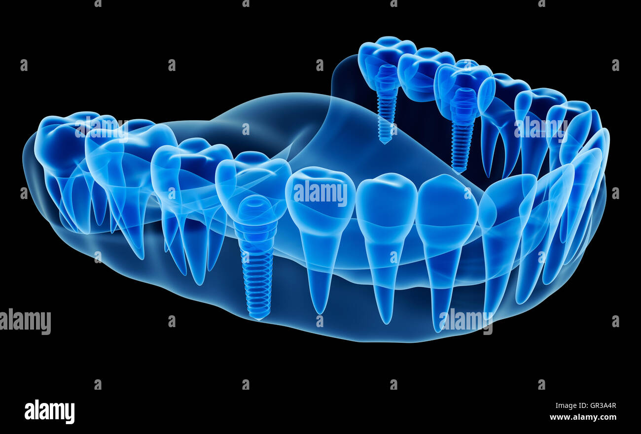 X-ray view of denture with implant Stock Photo - Alamy