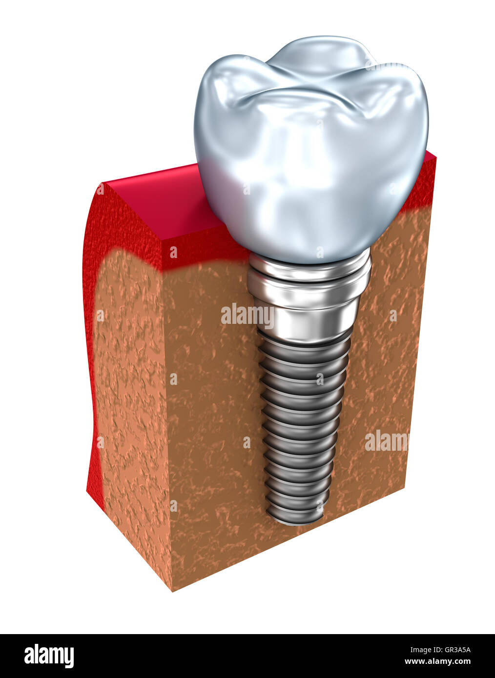 Dental implant - education model . 3D render Stock Photo - Alamy