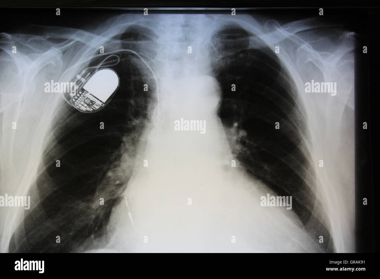 Pacemaker hi-res stock photography and images - Alamy