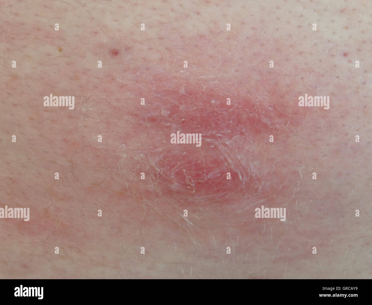 Insect bite hi-res stock photography and images - Alamy