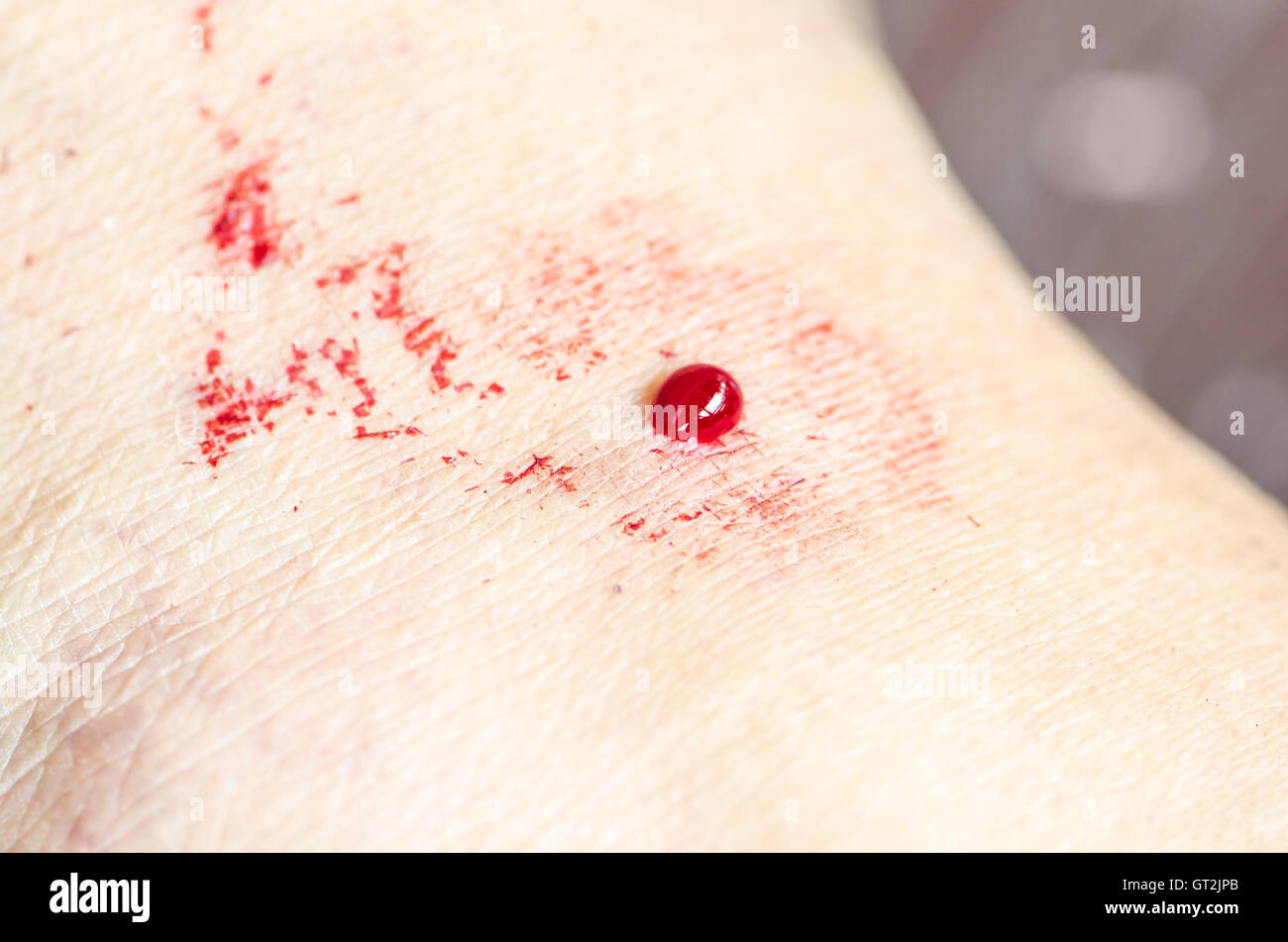Blood on the wound Stock Photo - Alamy