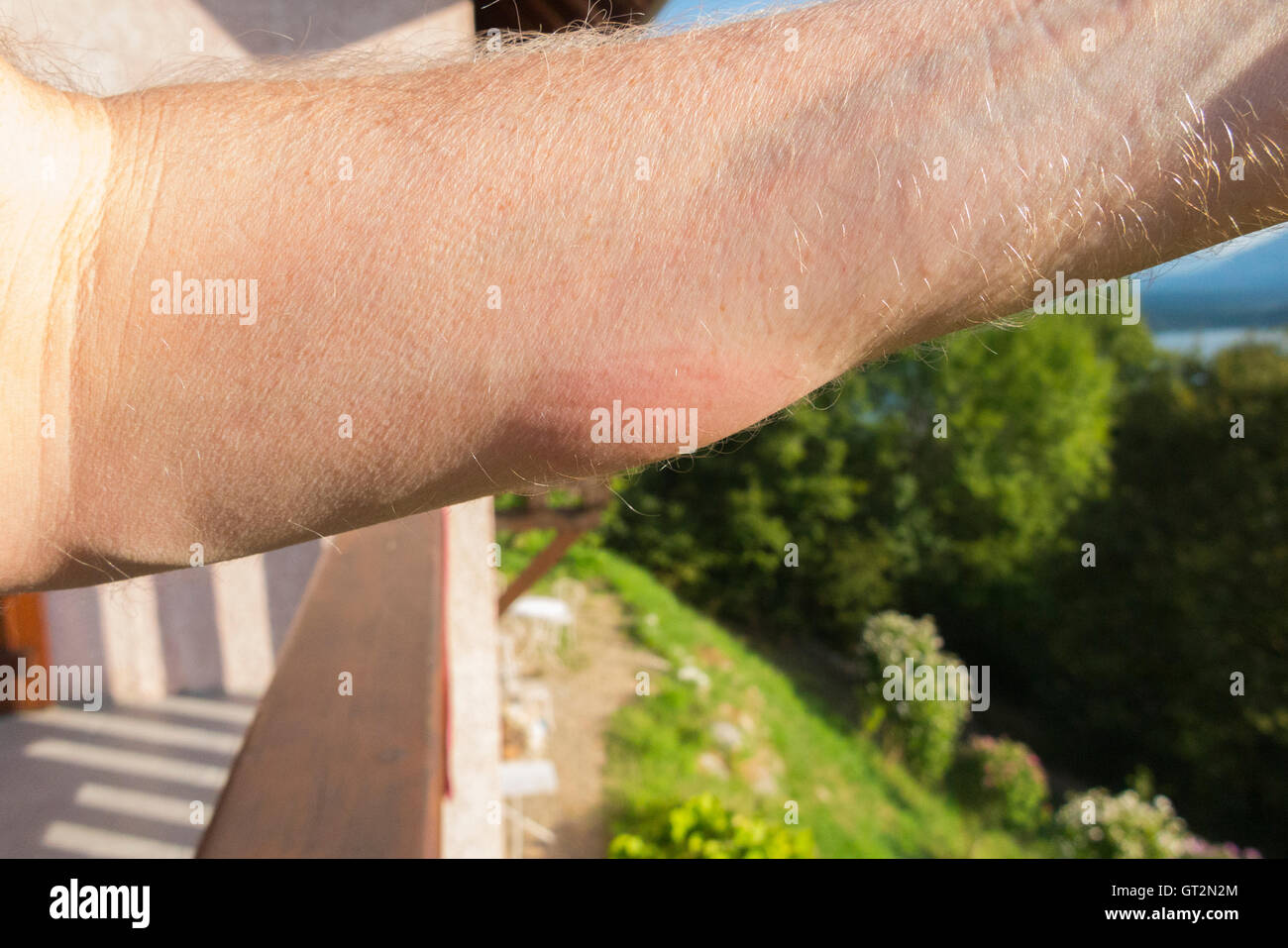 The raised arm of a British tourist swimmer with inflammation caused by ...