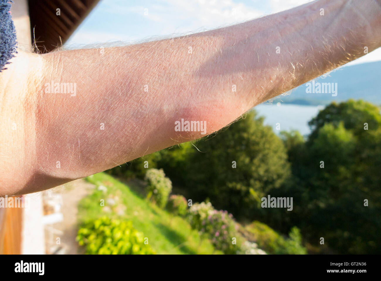 The raised arm of a British tourist swimmer with inflammation caused by ...
