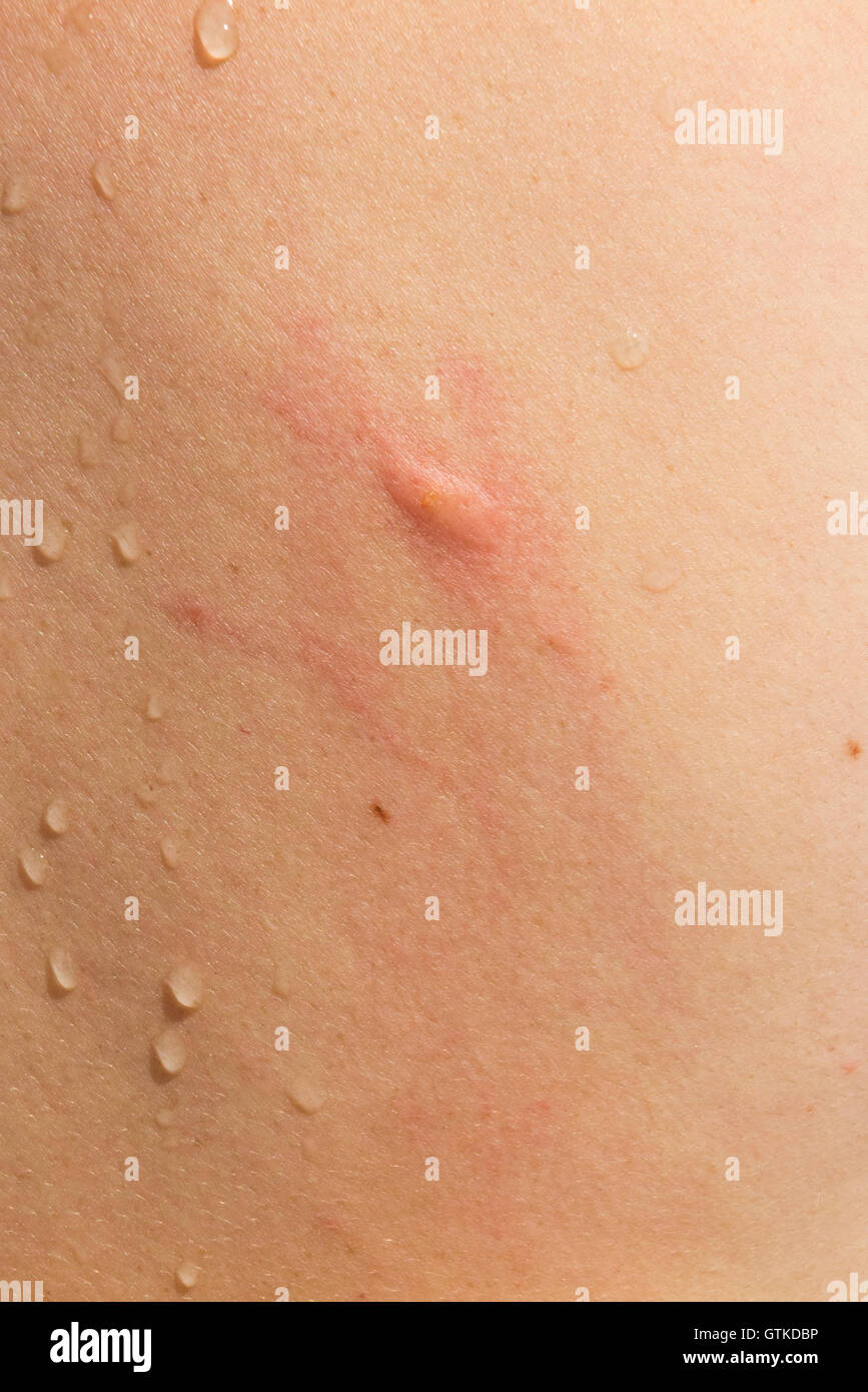 Tourist swimmer at Lac Du Bourget France with inflammation thought ...