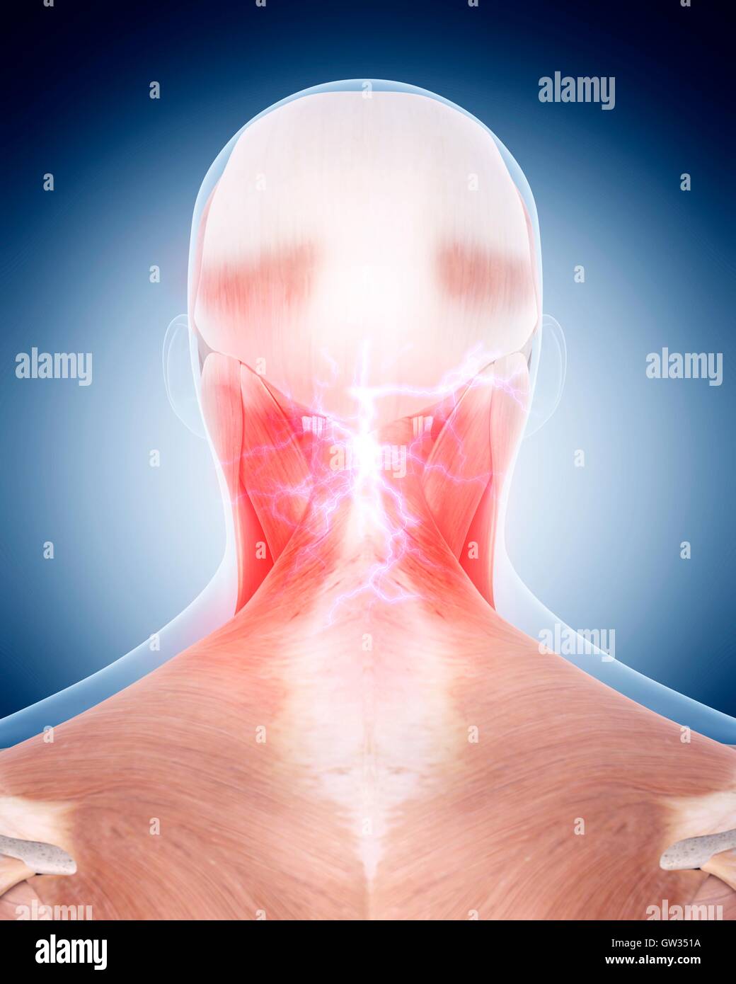 Human neck pain, illustration Stock Photo - Alamy