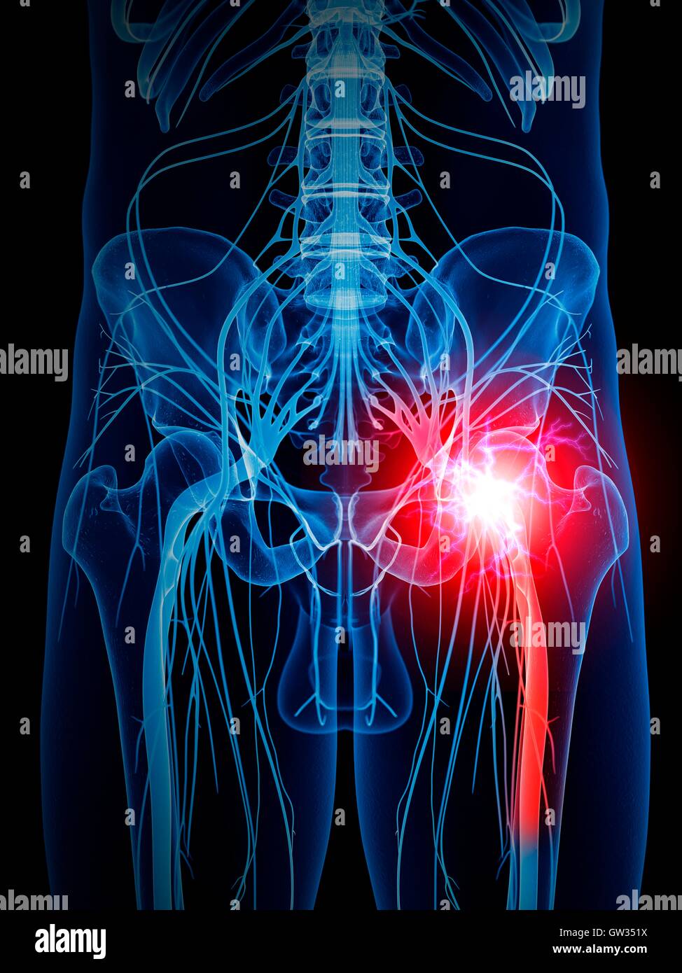 Human sciatic nerve pain, illustration Stock Photo - Alamy