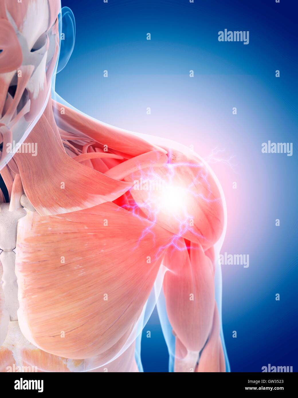 Human shoulder pain, illustration Stock Photo - Alamy