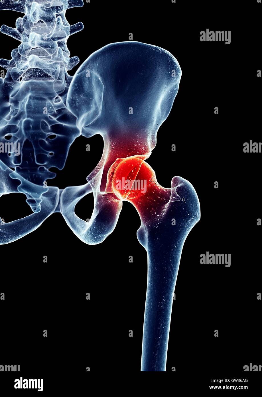 Human hip joint pain, illustration Stock Photo - Alamy
