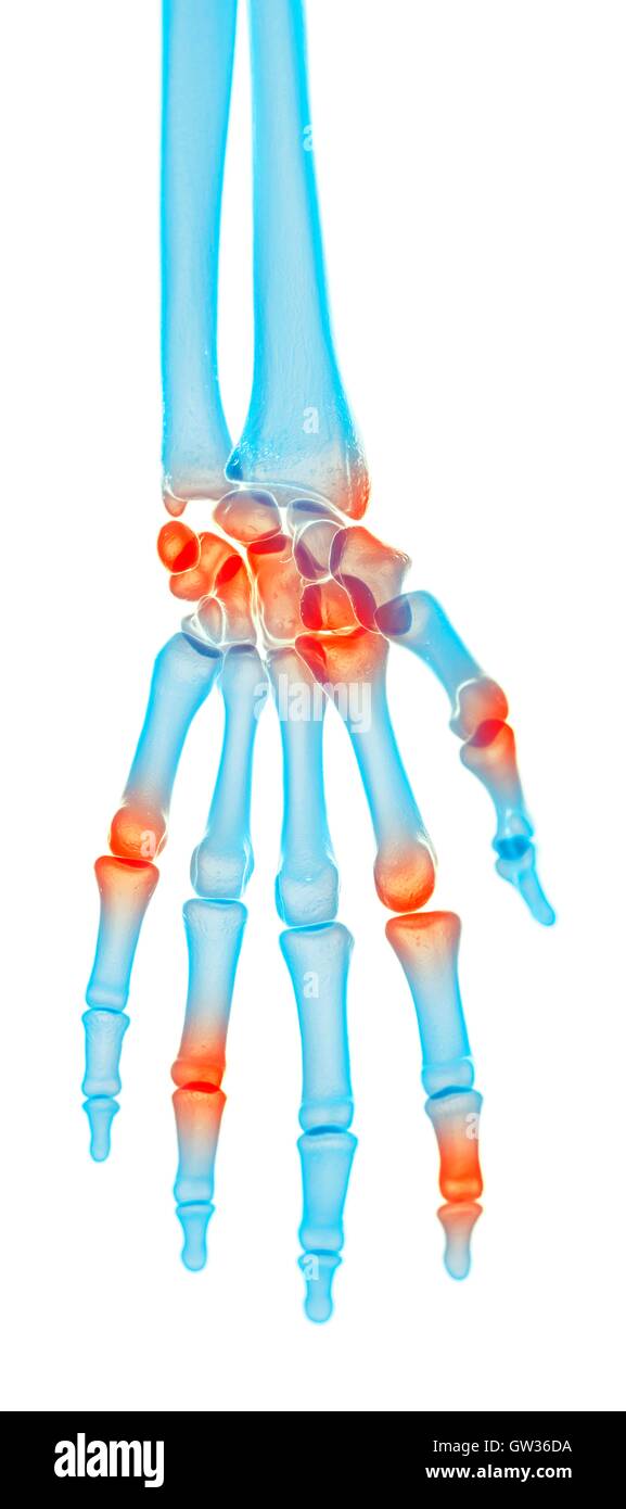 Human hand pain, illustration Stock Photo - Alamy