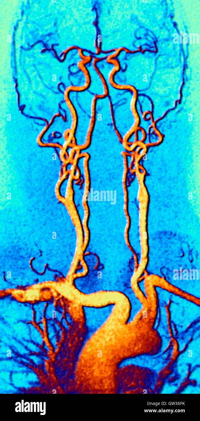 Chest, neck and head arteries. Coloured magnetic resonance angiography ...