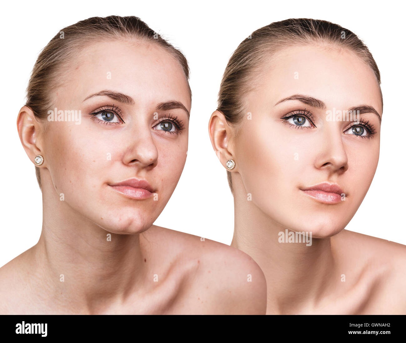 Skin problem hi-res stock photography and images - Alamy