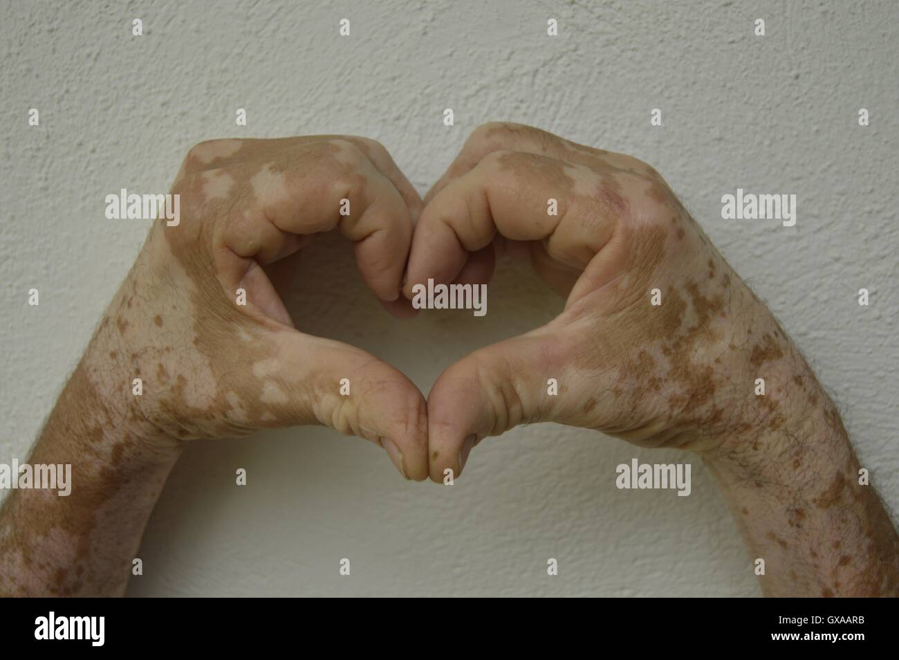 Hand and forearm of a man with vitiligo condition of the skin. Hands ...