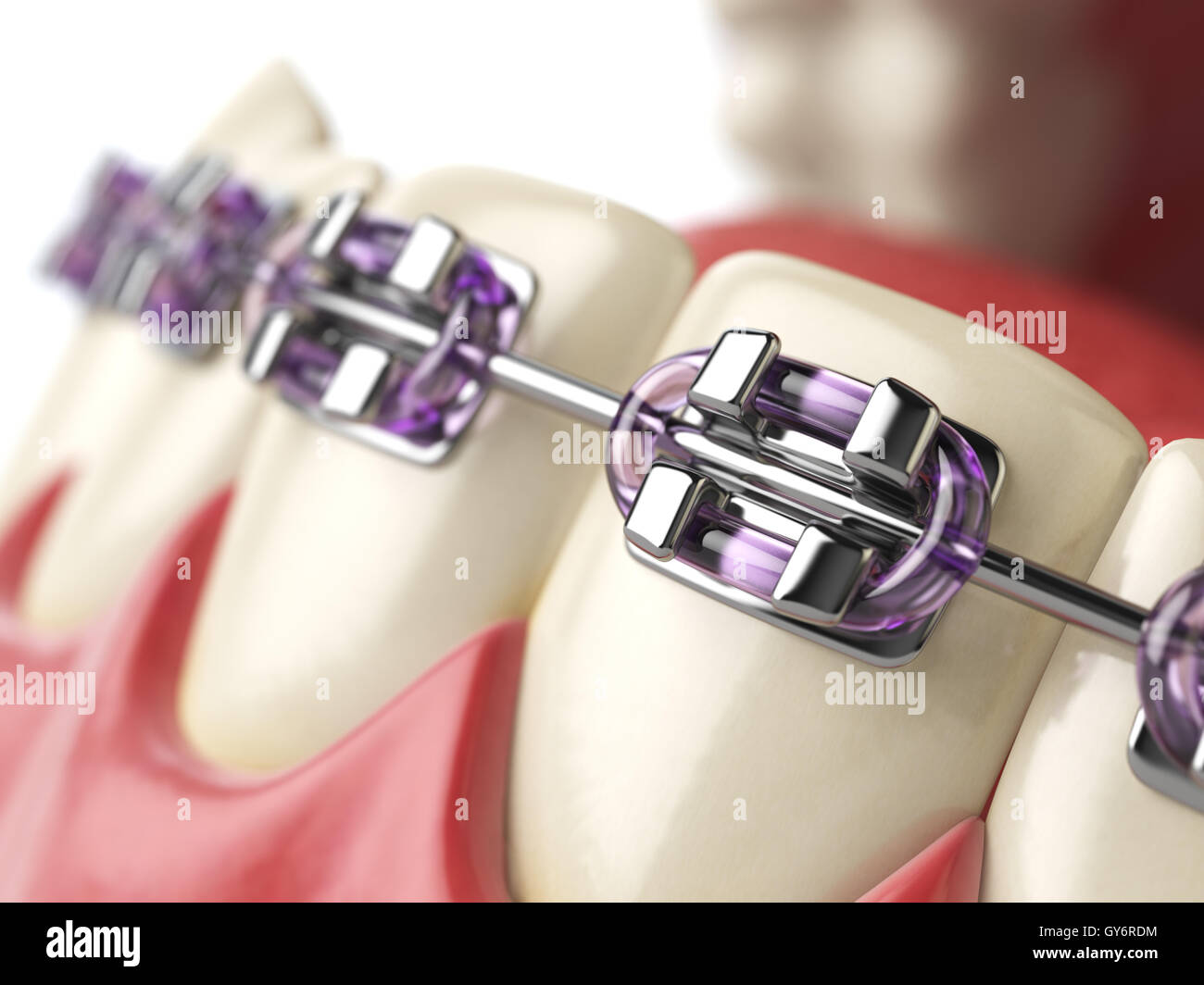 Teeth with braces or brackets in open human mouth. Dental care concept ...