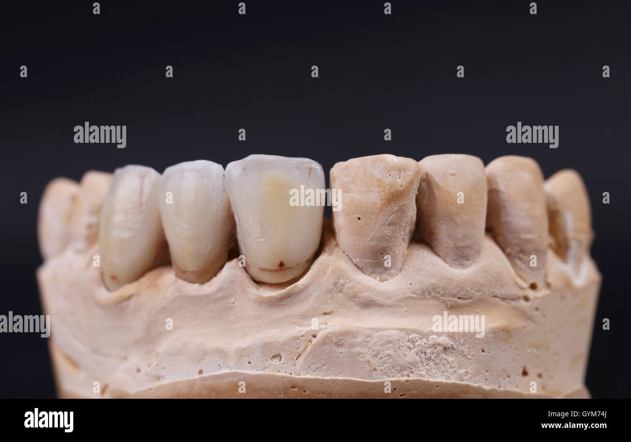 Close up of dental prothetic jaw Stock Photo - Alamy