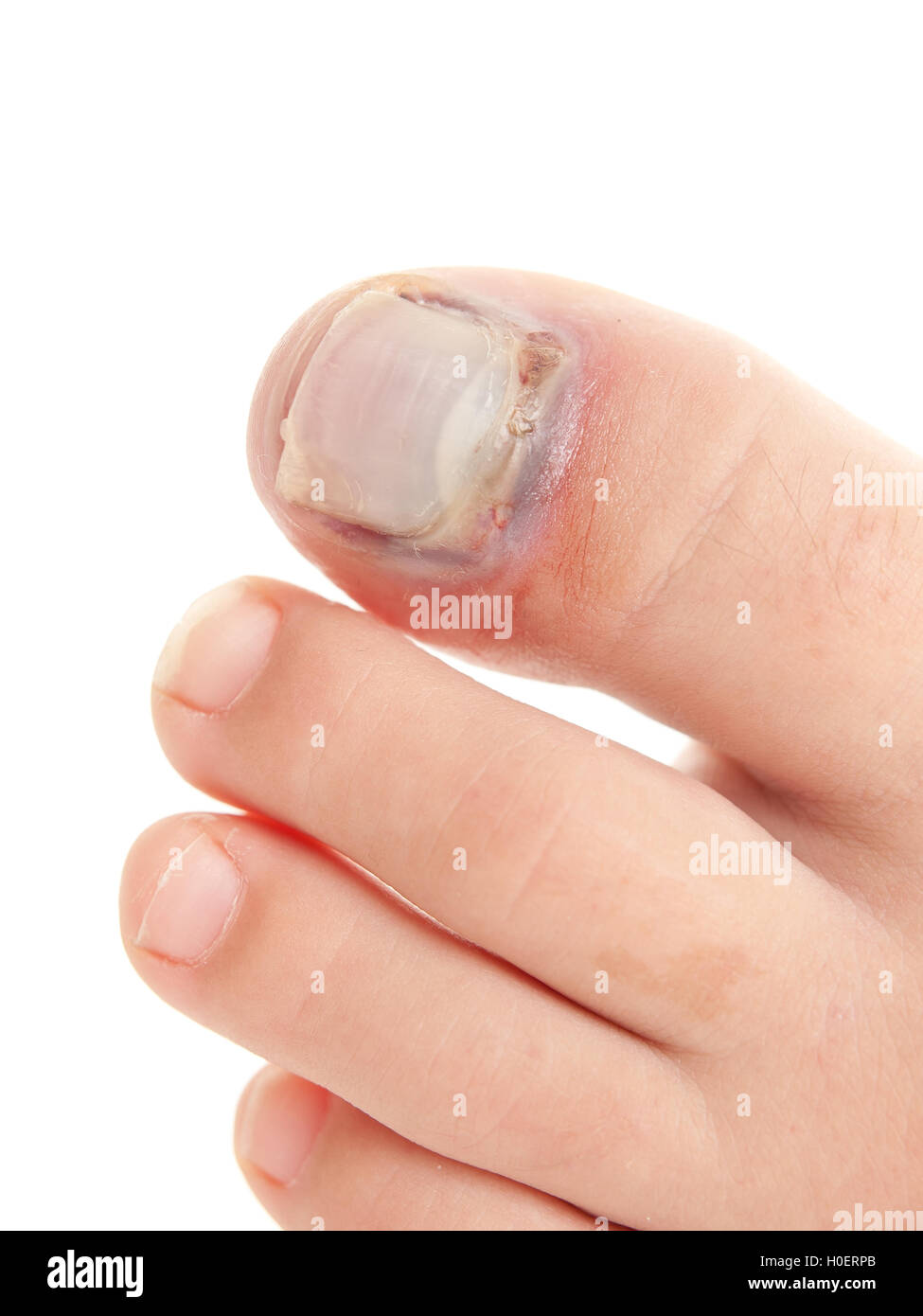 Broken big toe with nail detachment on pure white background Stock ...