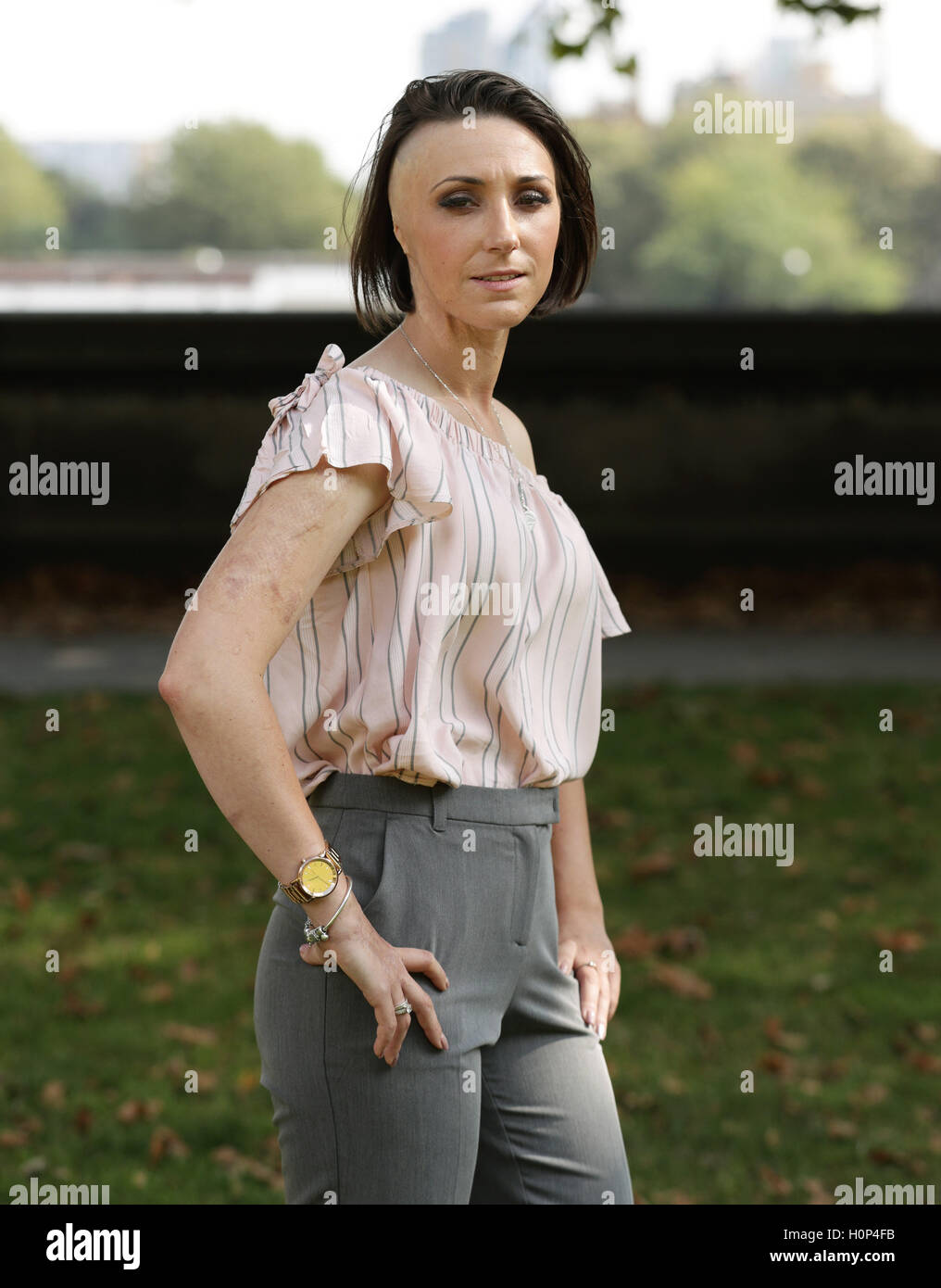 Adele Bellis, 24, who was scarred for life in an acid attack ...