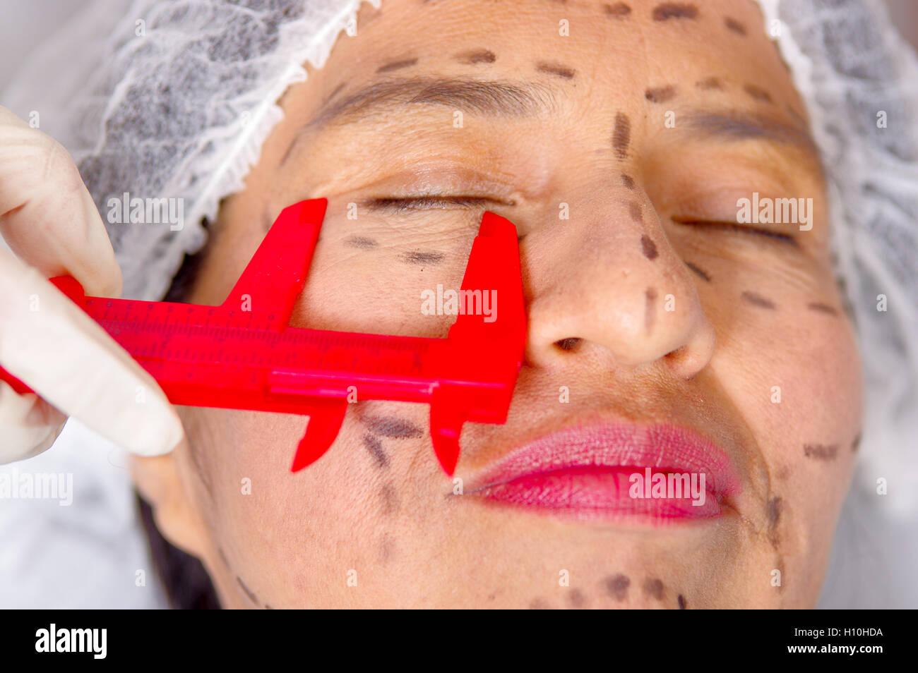 Closeup womans face preparing for cosmetic surgery with lines drawn on ...