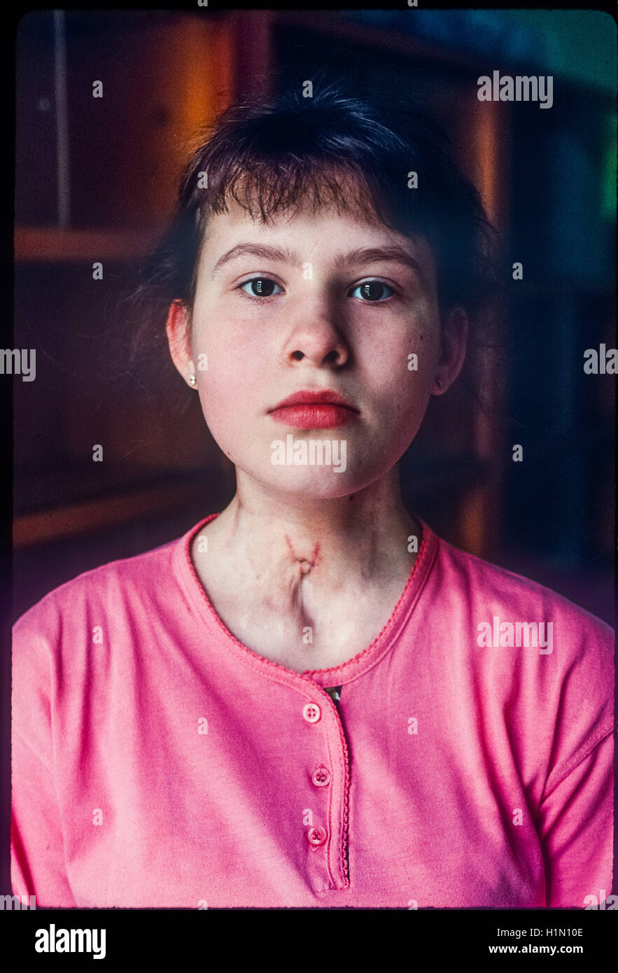 Children cancer hi-res stock photography and images - Alamy