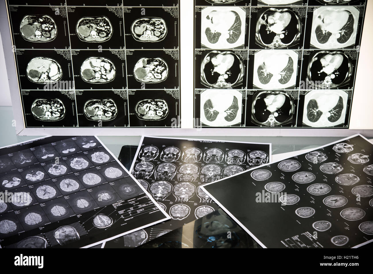 CT scan and MRI results Stock Photo - Alamy