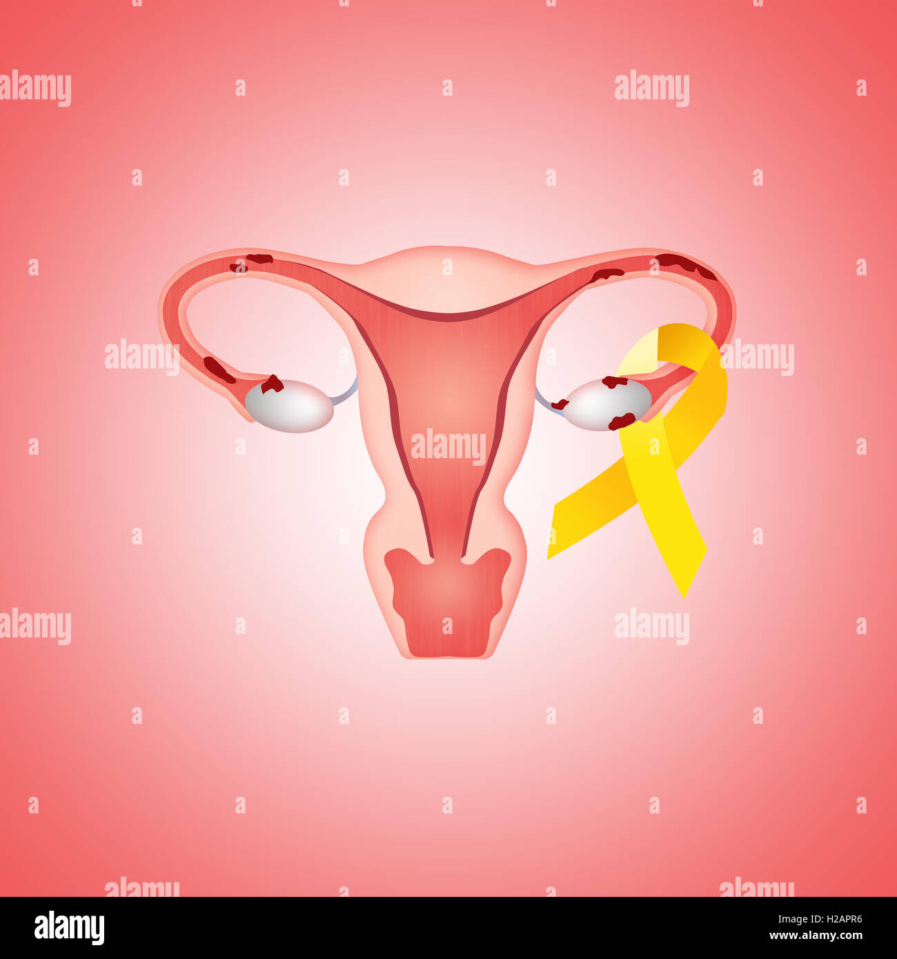 uterus with endometriosis and yellow ribbon Stock Photo - Alamy