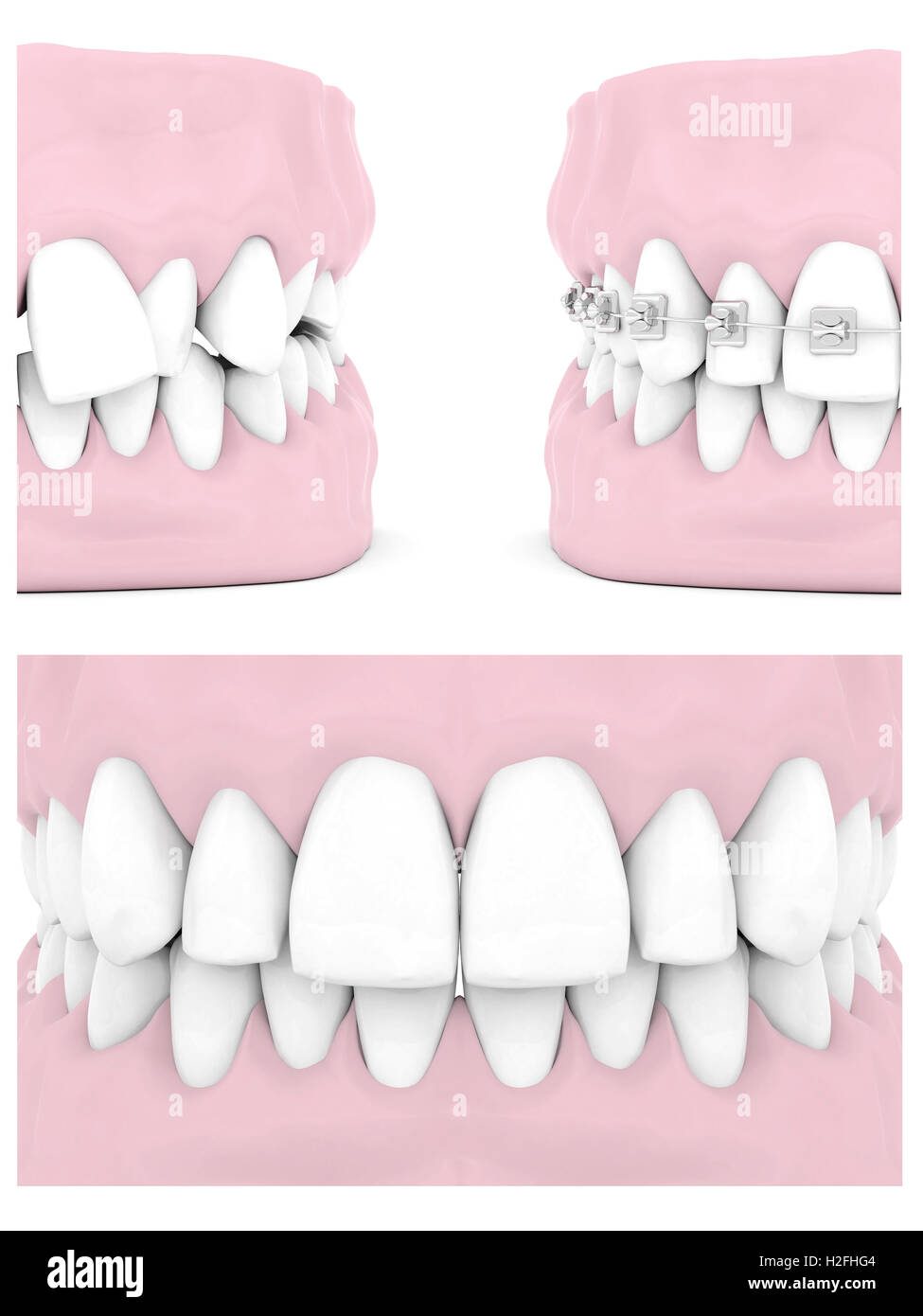 Dentistry and braces hi-res stock photography and images - Alamy