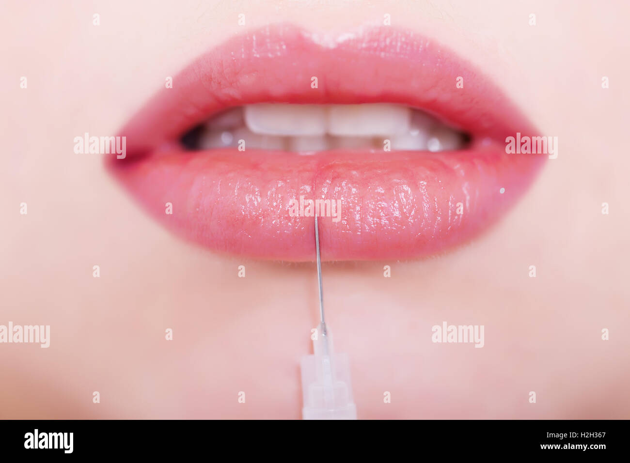 Beauty medical injection for the perfect lips Stock Photo - Alamy