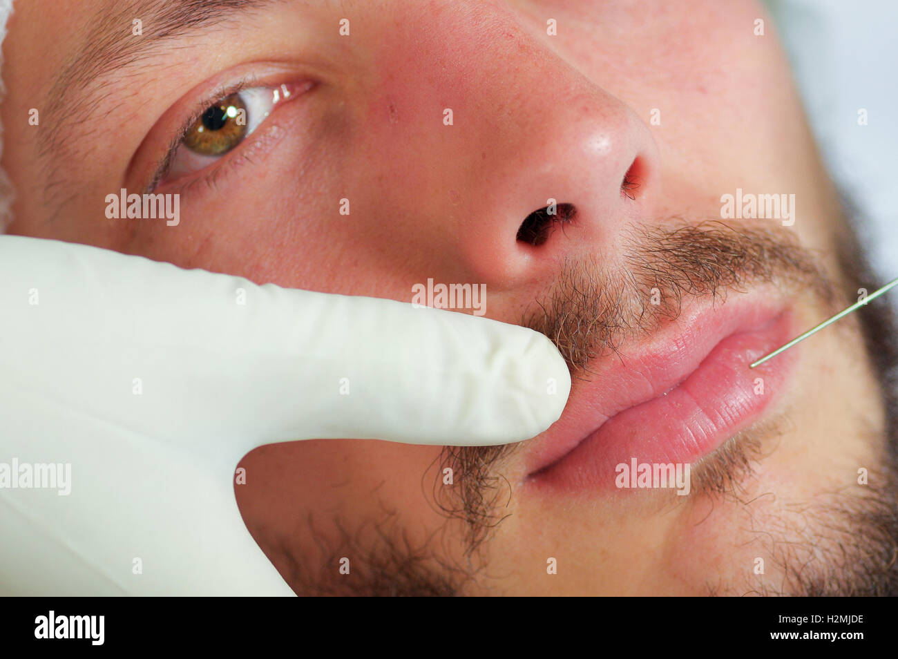 Closeup young mans face receiving facial cosmetic treatment injections ...