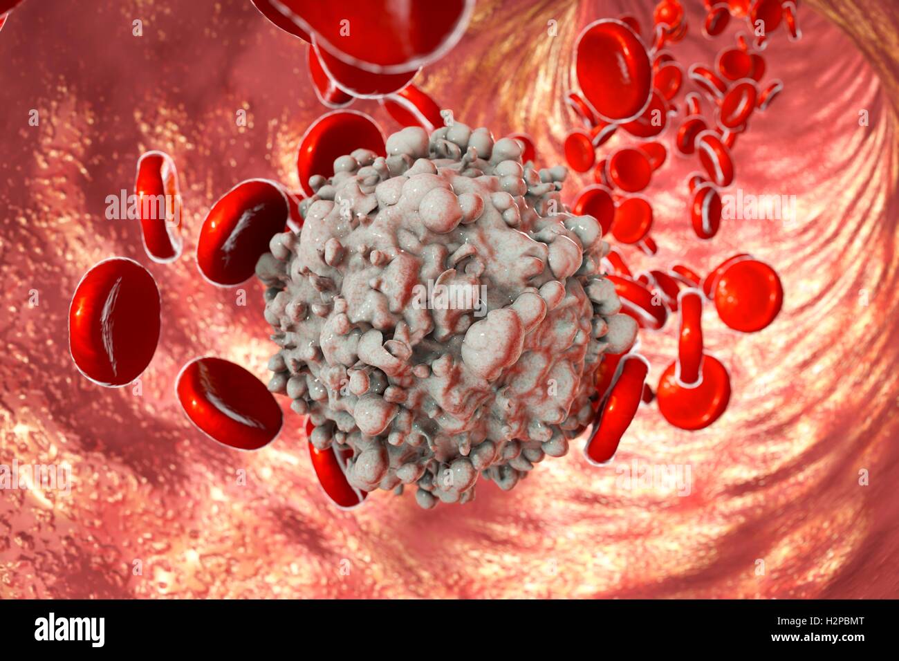Computer illustration of red blood cells and a cancerous leukaemia ...