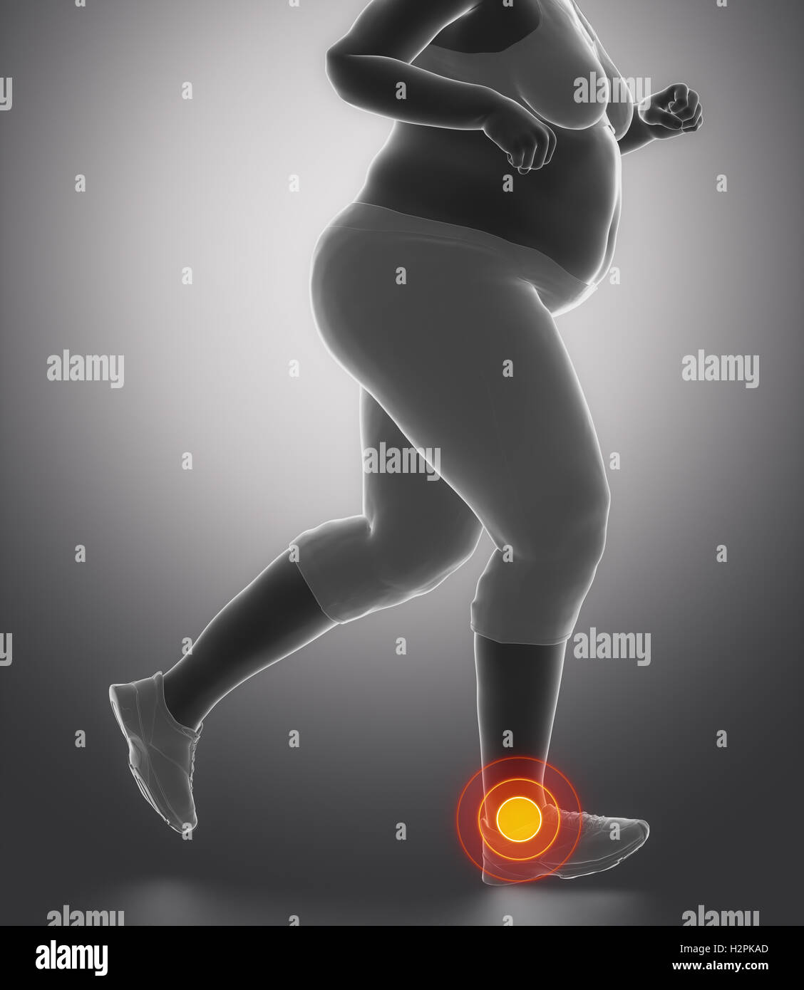 Obesity ankle problem Stock Photo - Alamy