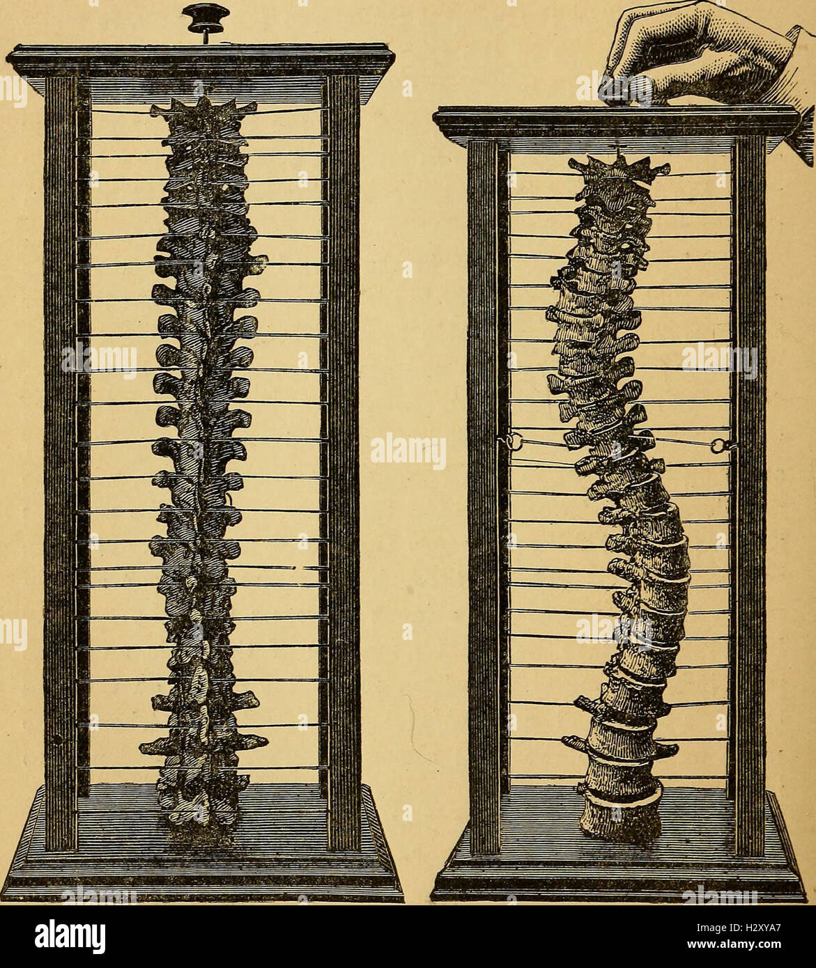 A 19th-century medical work detailing treatments for spinal diseases ...