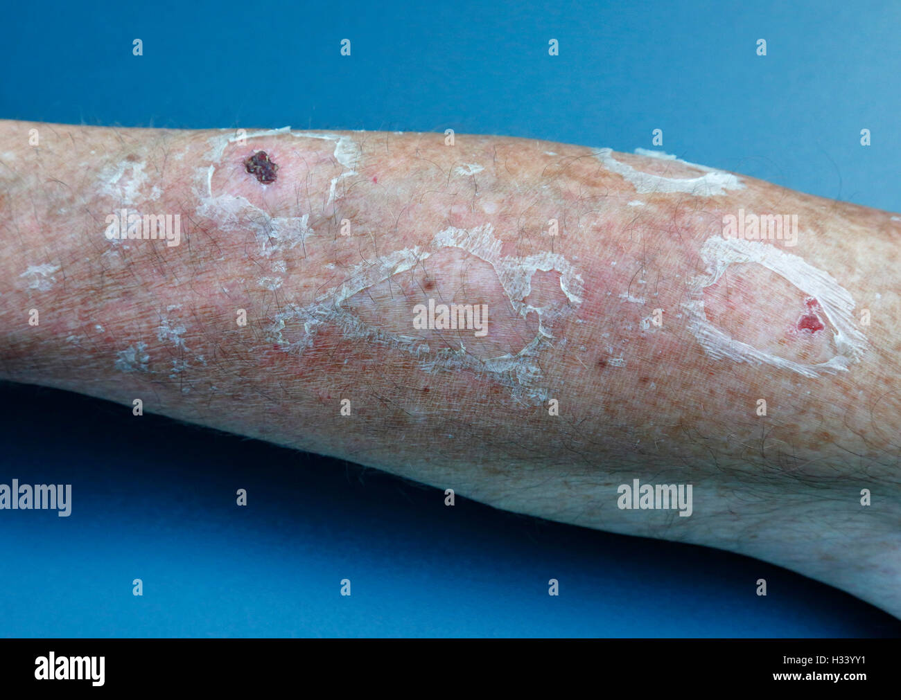 health, medicines, forearm skin damage, blistering and peeling skin ...