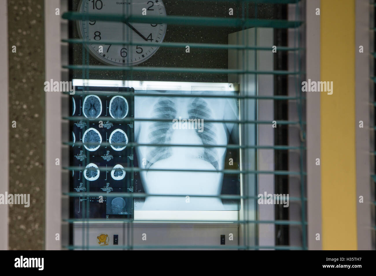 X-Rays on a hospital lightbox Stock Photo - Alamy