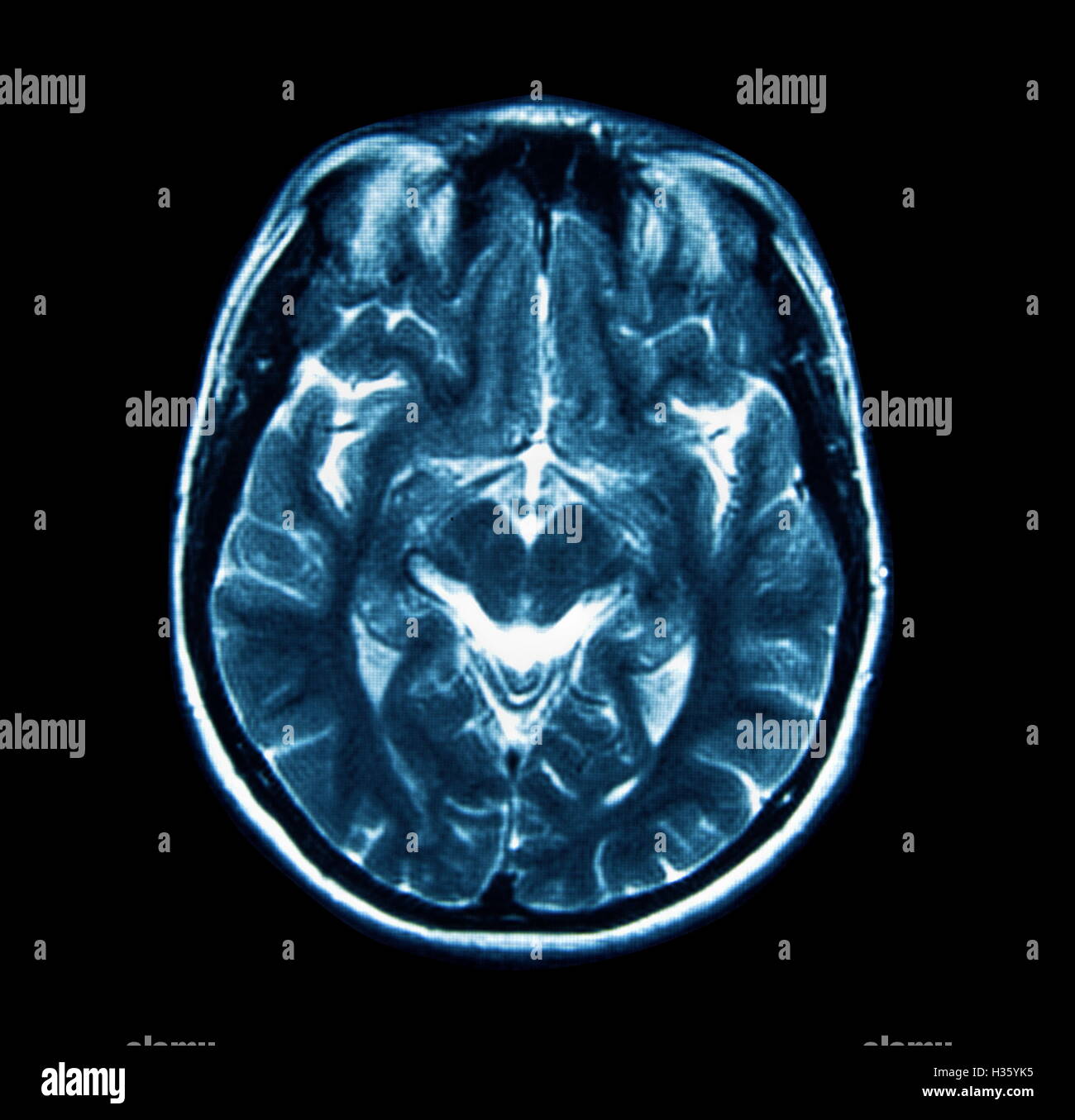 Brain scan analysis hi-res stock photography and images - Alamy