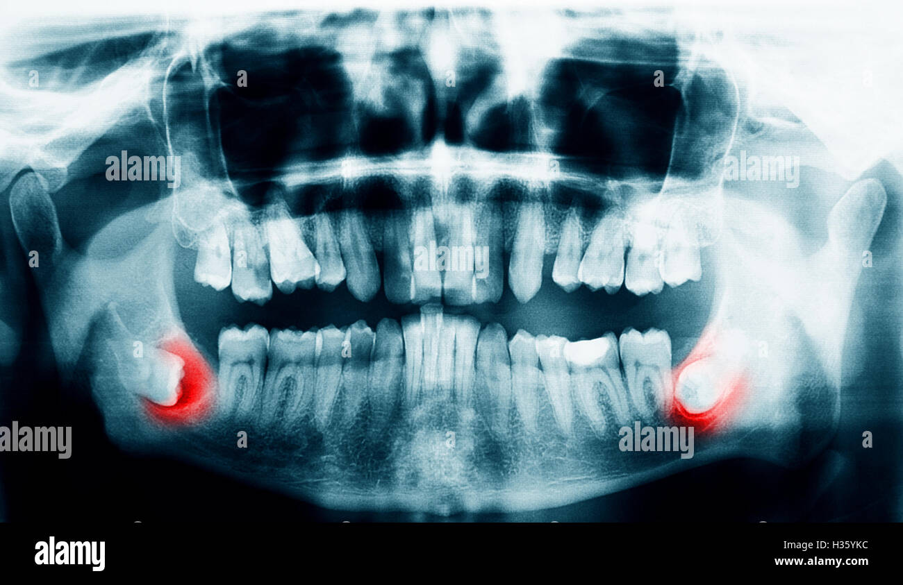 Teeth xray hi-res stock photography and images - Alamy