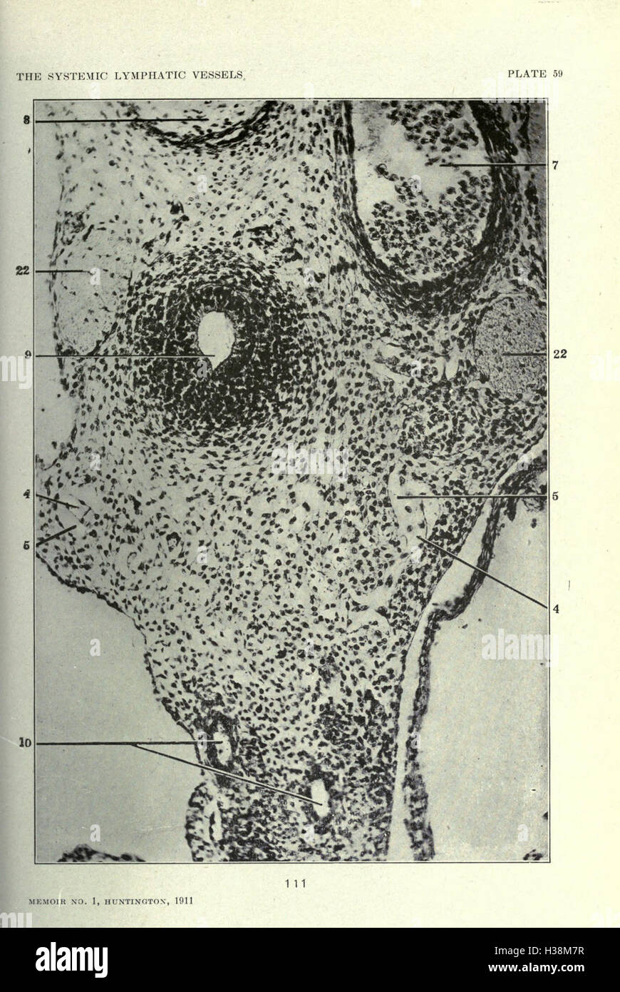 Disorders lymphatic system hi-res stock photography and images - Alamy