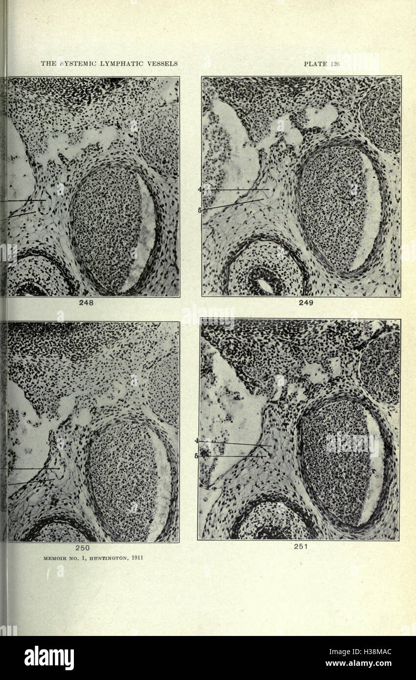 Lymphatic mapping hi-res stock photography and images - Alamy
