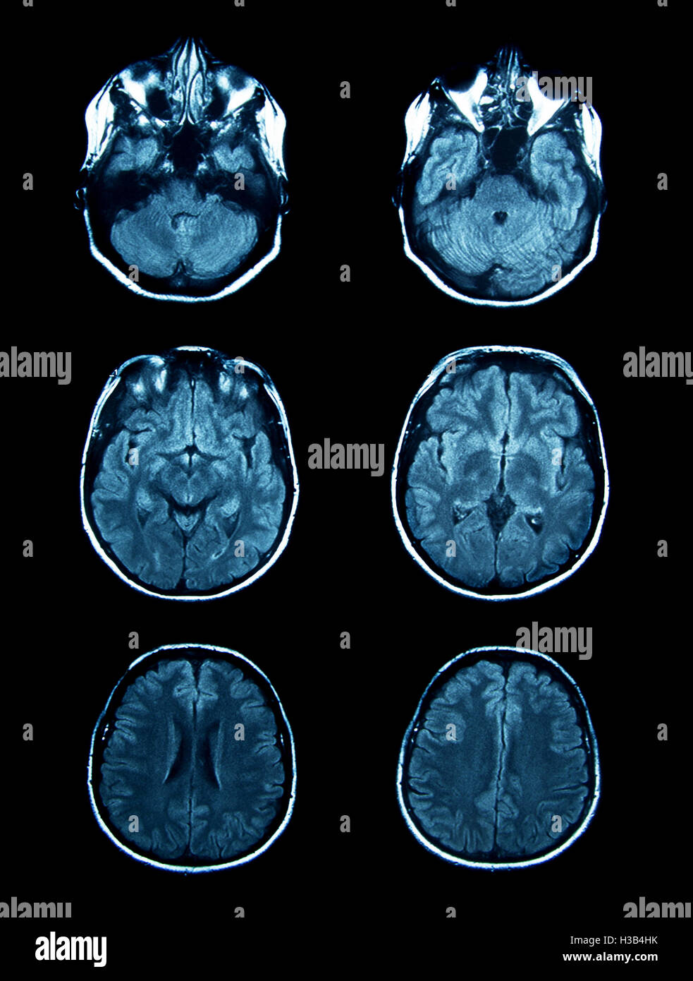 Mri scans hi-res stock photography and images - Alamy