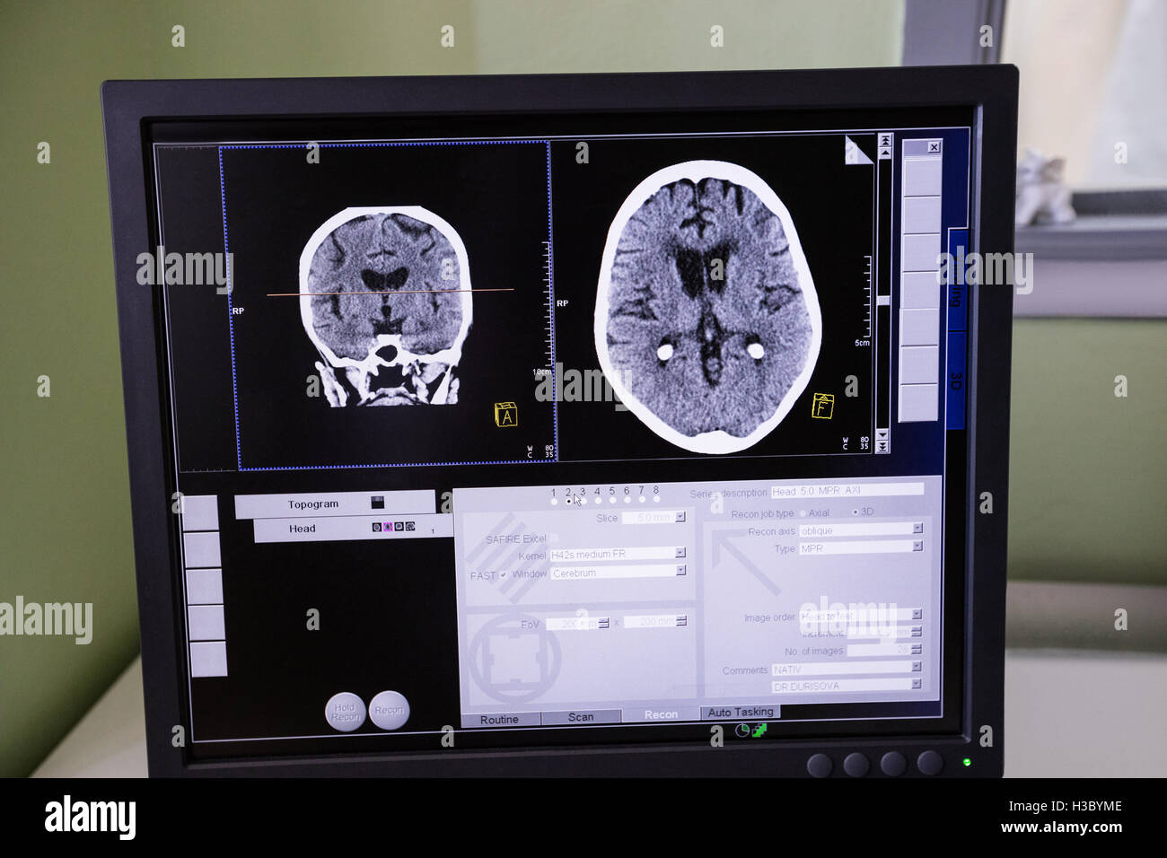 Digital brain scan on computer monitor Stock Photo - Alamy