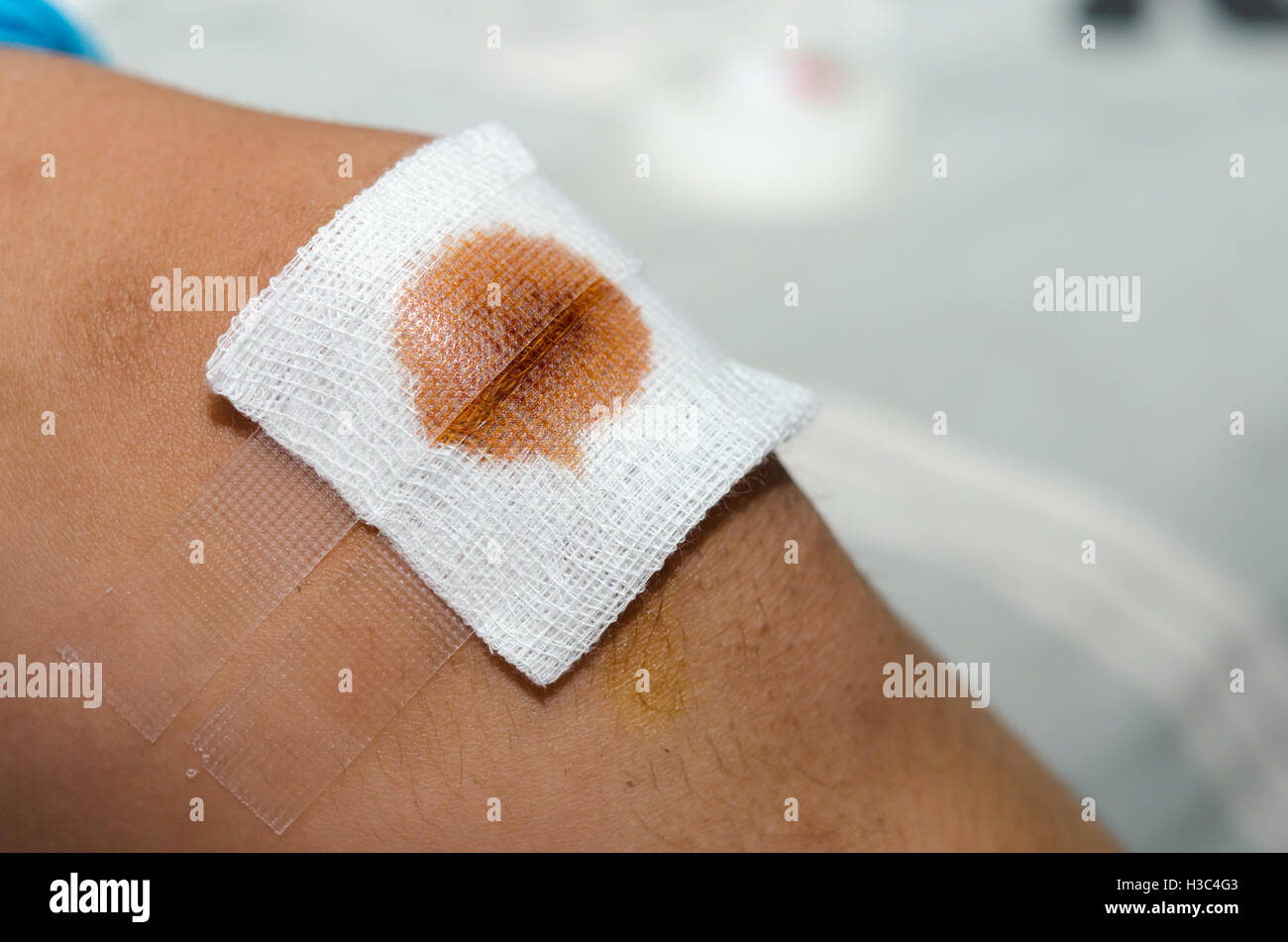 Clamp out the cotton wool wound to the knee Stock Photo - Alamy