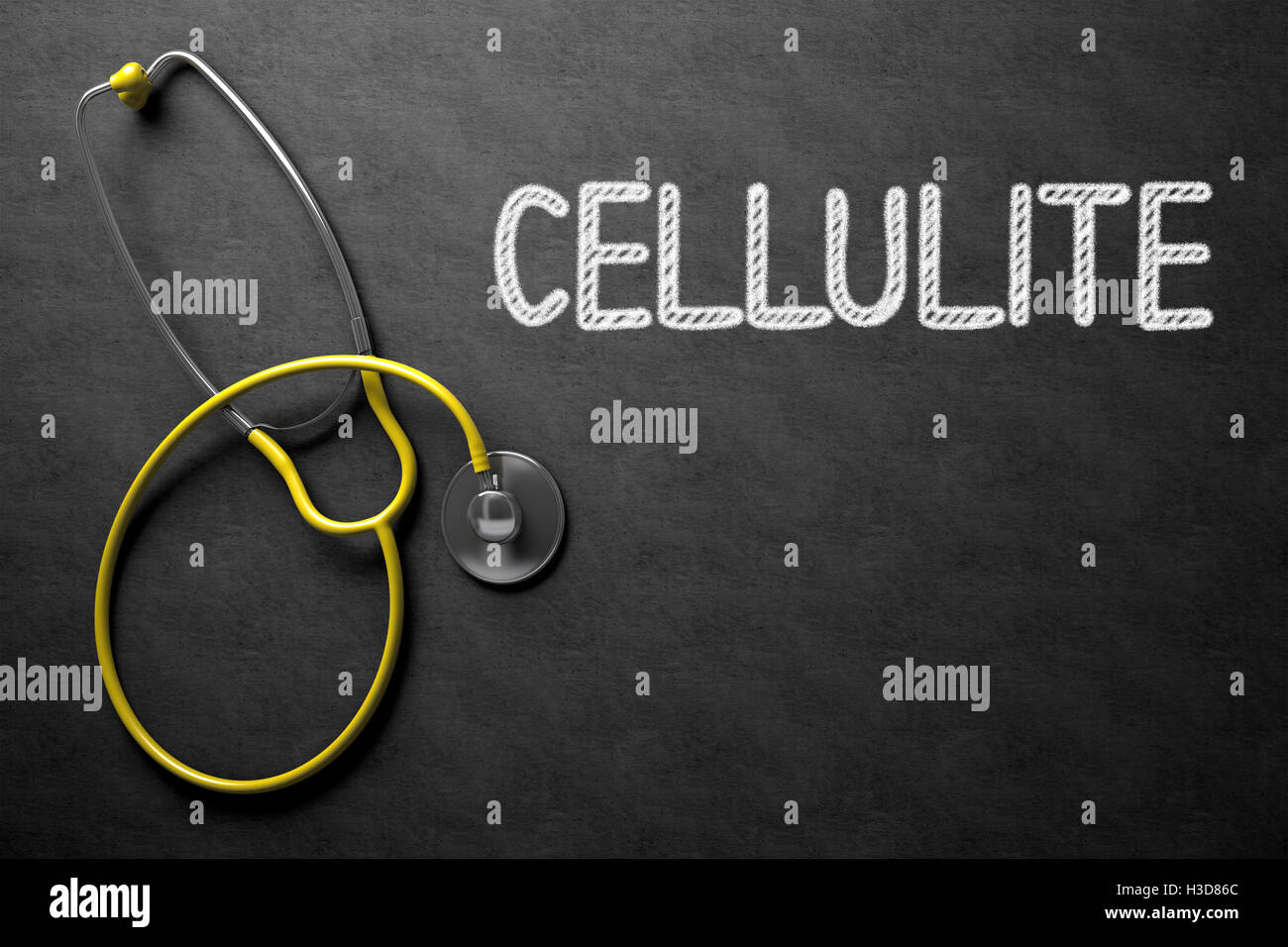 Cellulitis hi-res stock photography and images - Alamy