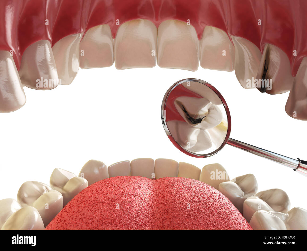 Human tooth with cariesand hole and tools. Dental searching concept ...
