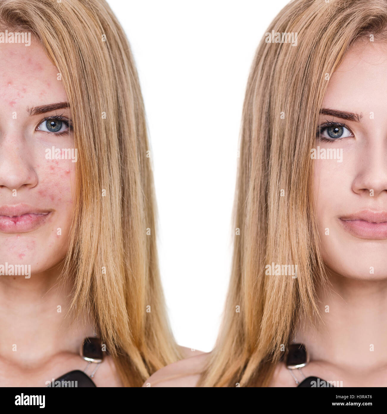 Girl with acne before and after treatment Stock Photo - Alamy