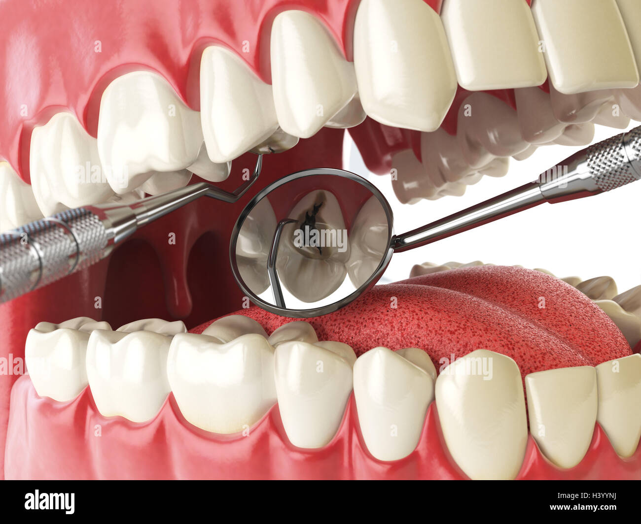 Human tooth with cariesand hole and tools. Dental searching concept ...