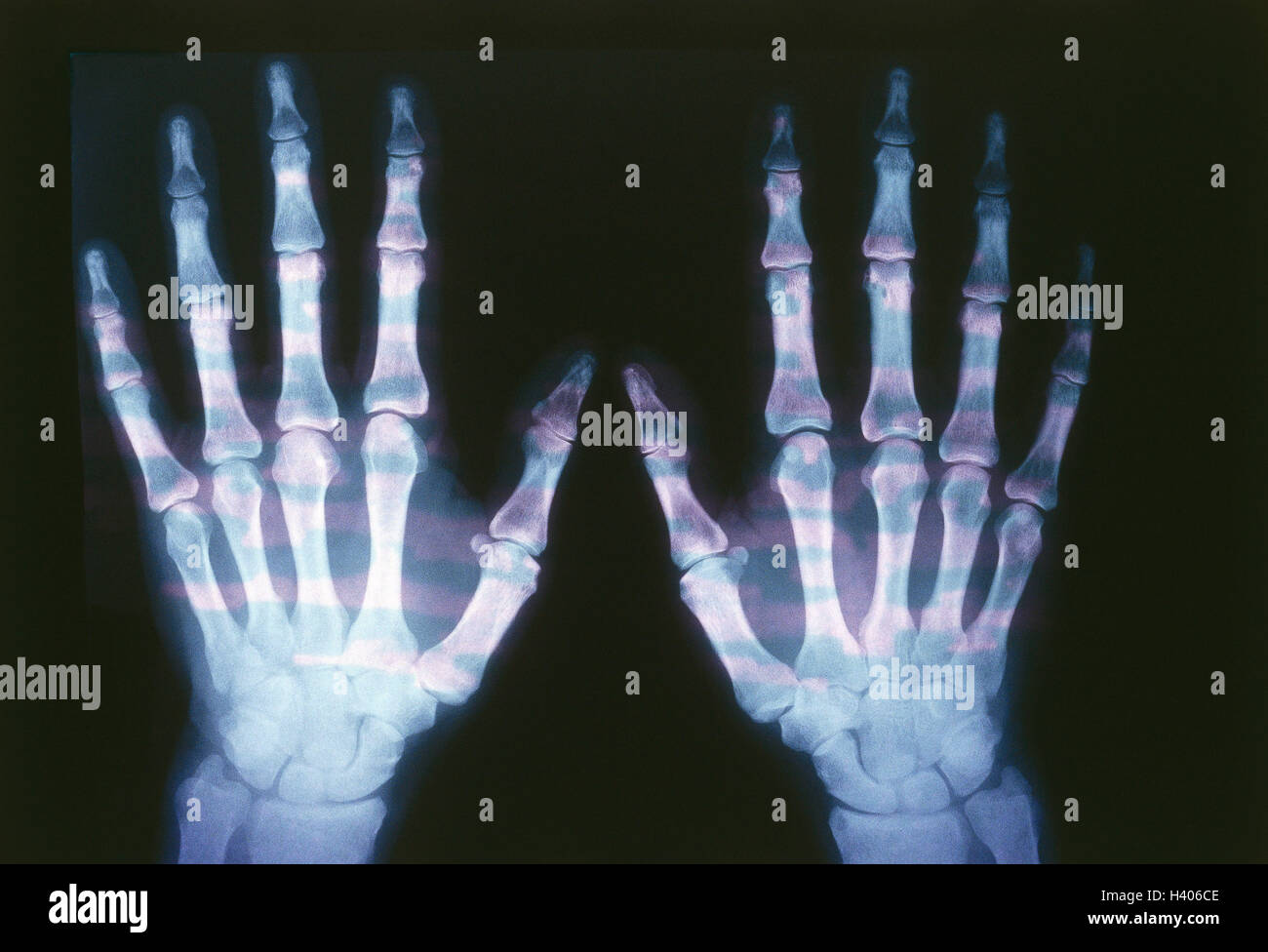 Roentgenogram, hands, representation, arthrosis / holarthritis Stock ...