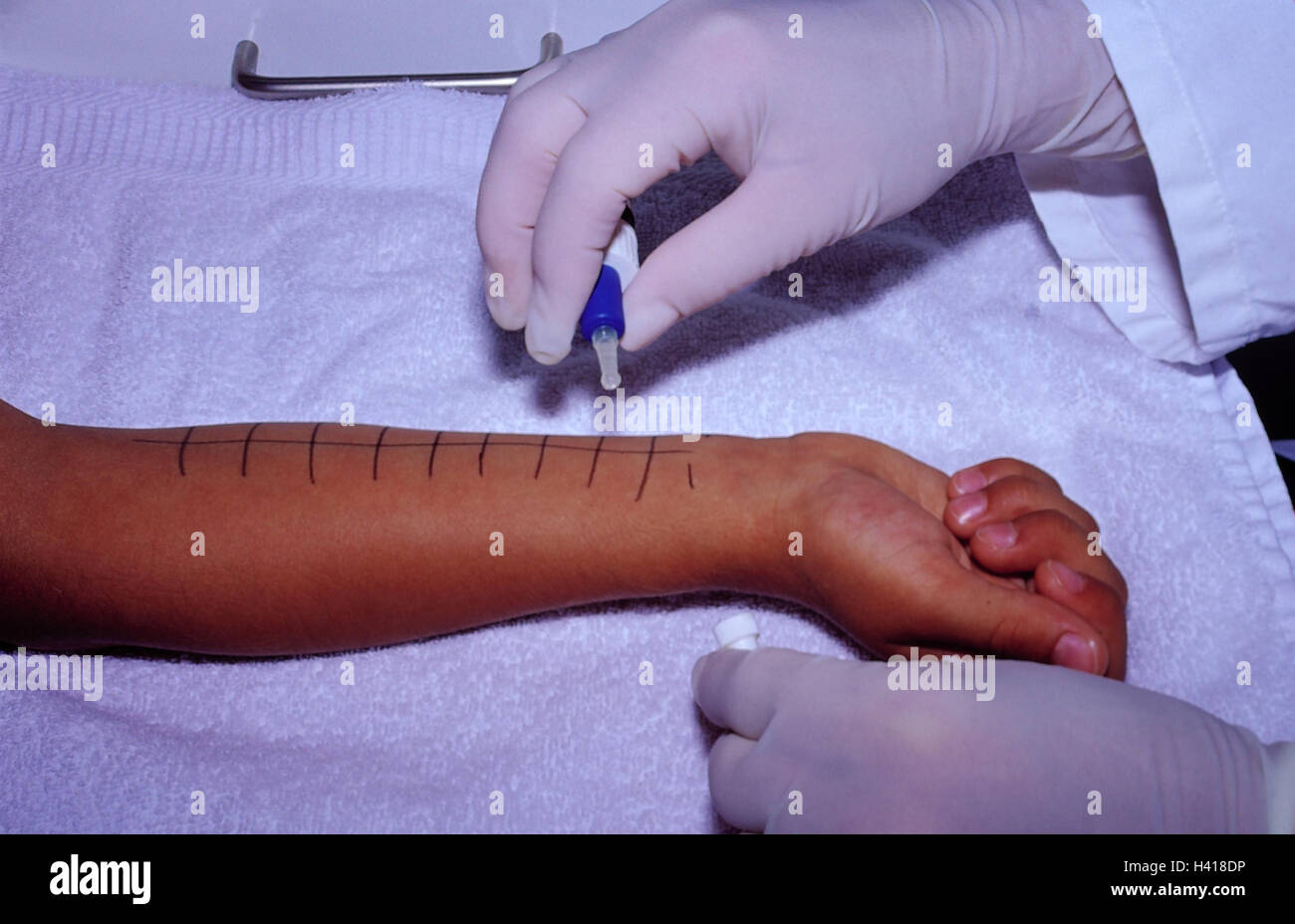 Allergy test, Prick test, patient, child, forearm, assistant, test ...